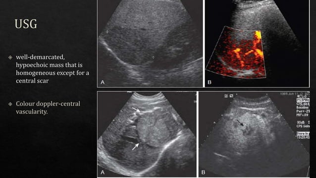 Imaging of benign focal hepatic lesions | PPTX