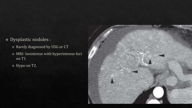Imaging of benign focal hepatic lesions | PPTX