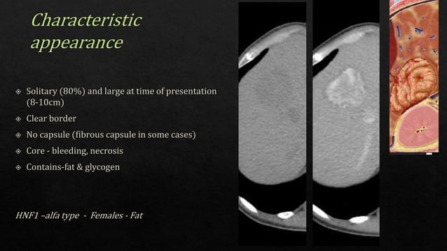 Imaging of benign focal hepatic lesions | PPTX