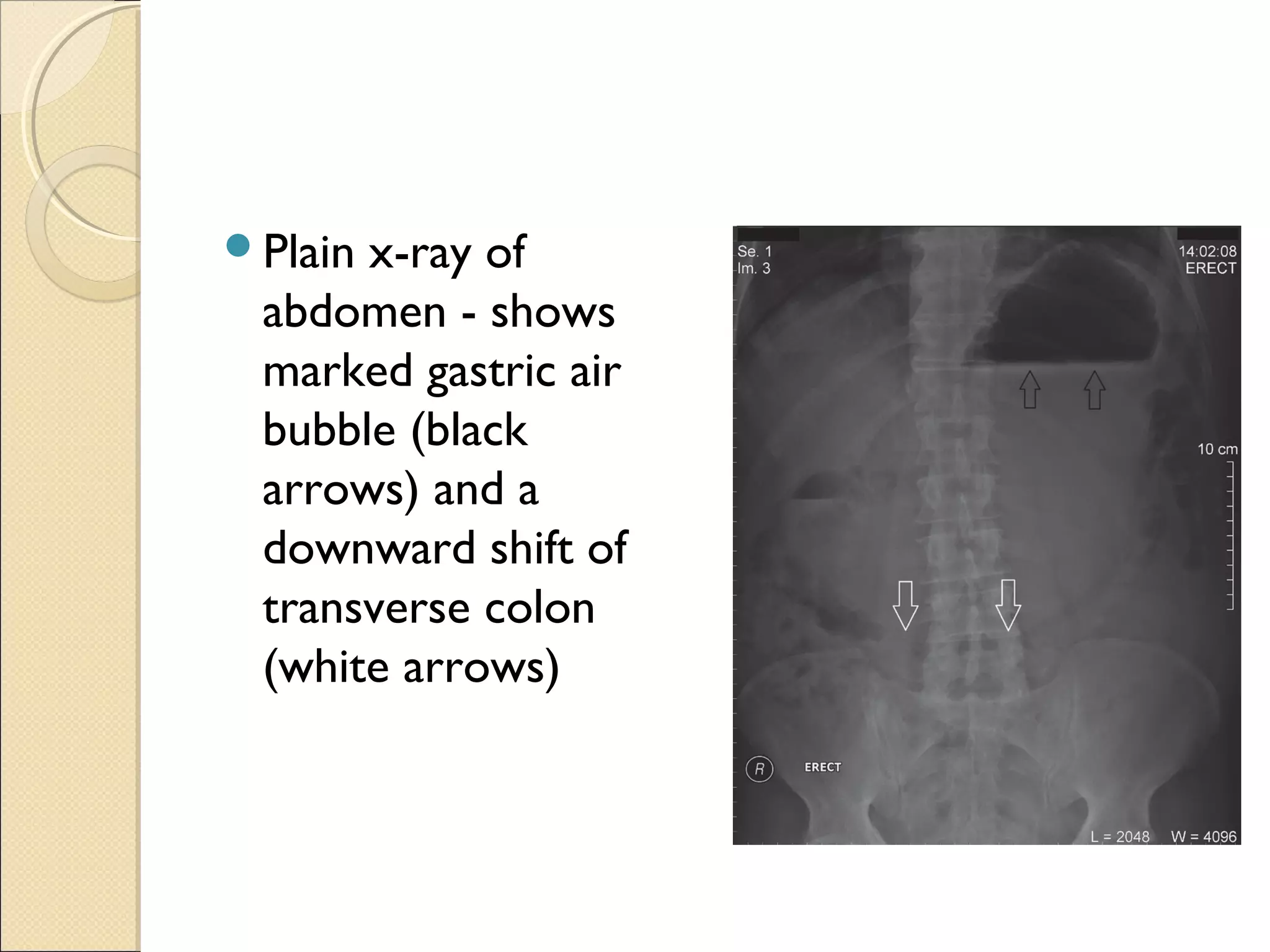 Benign gastric outlet obstruction | PPT