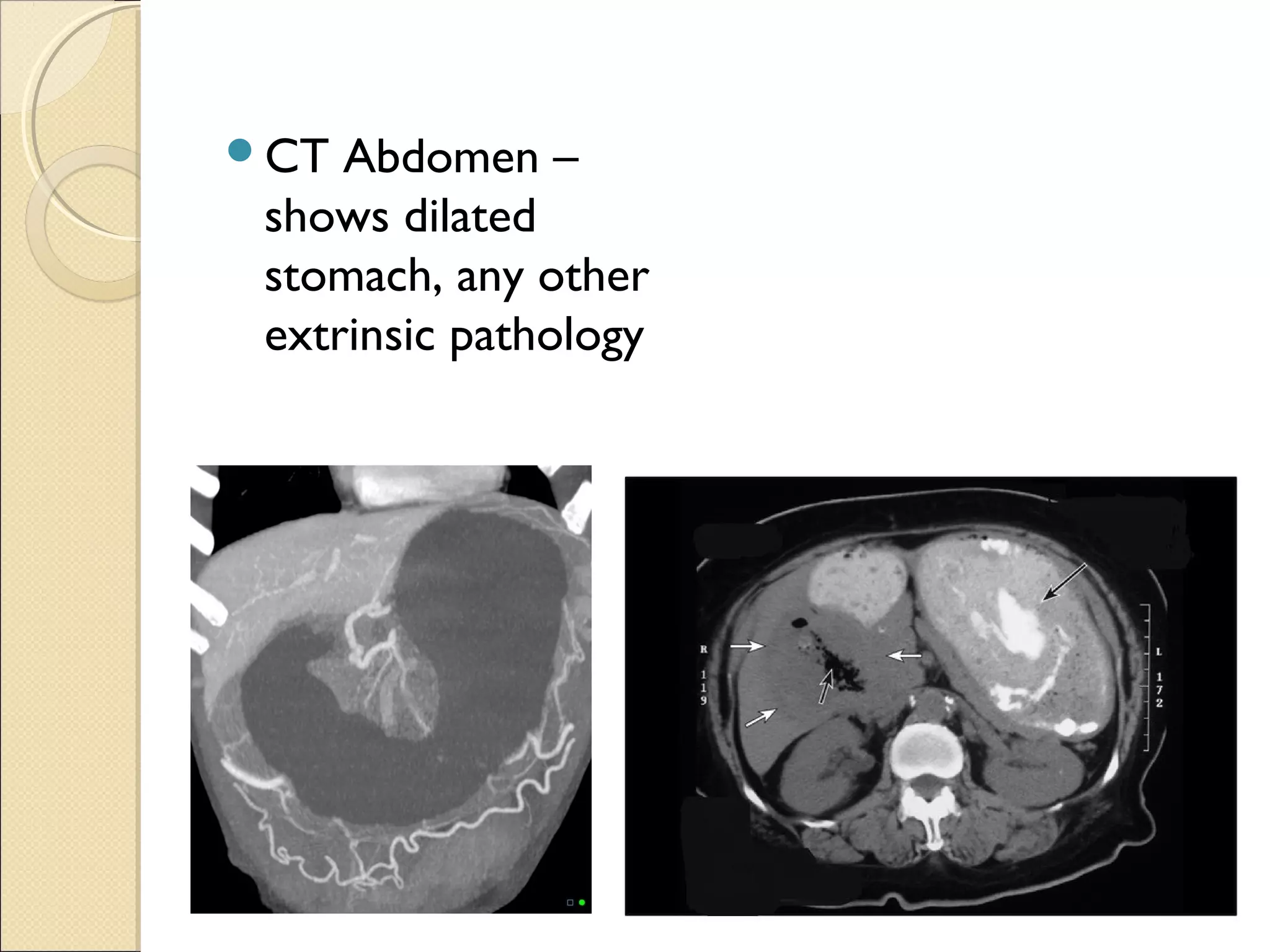 Benign gastric outlet obstruction | PPT