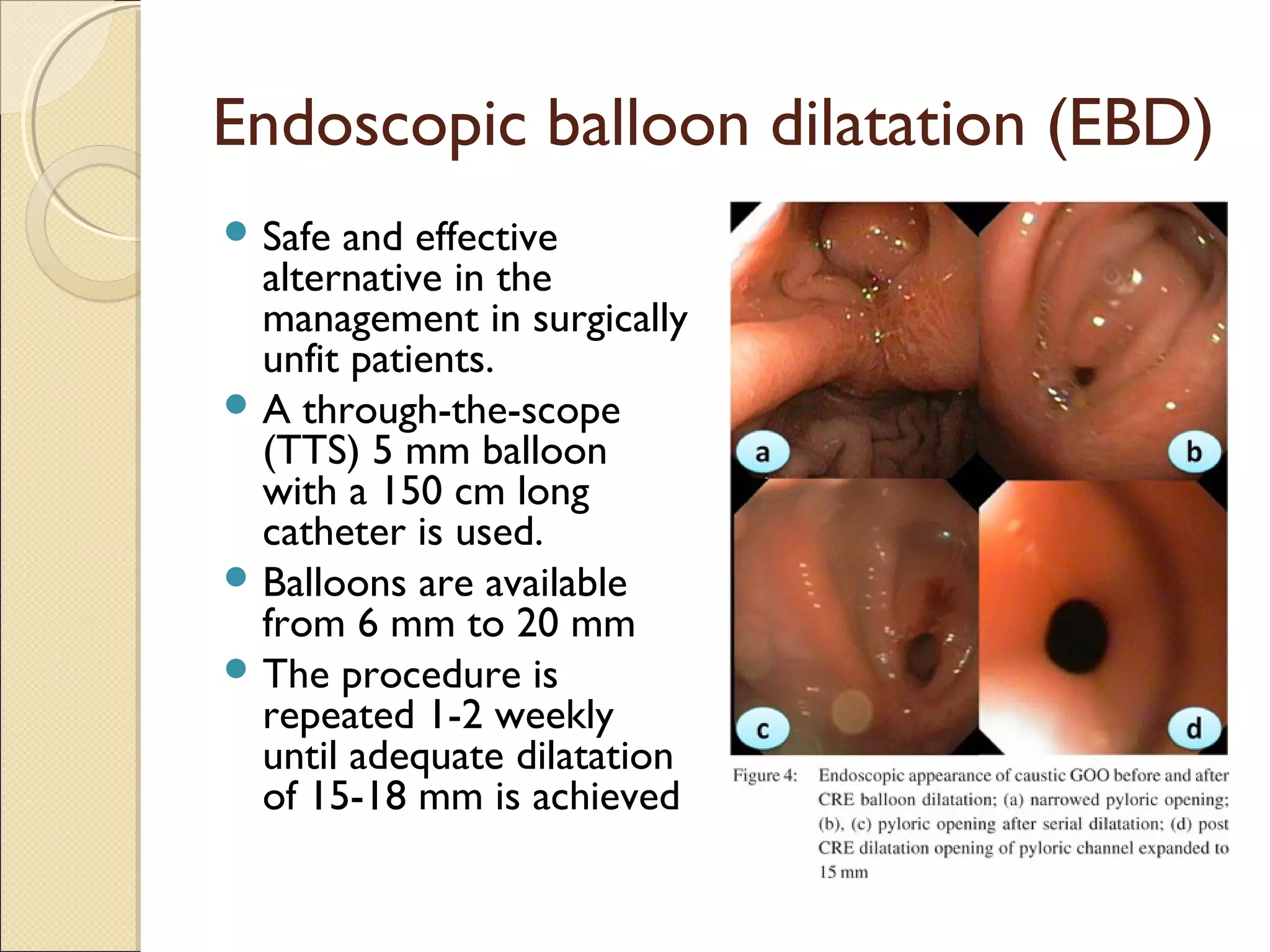 Benign gastric outlet obstruction | PPT