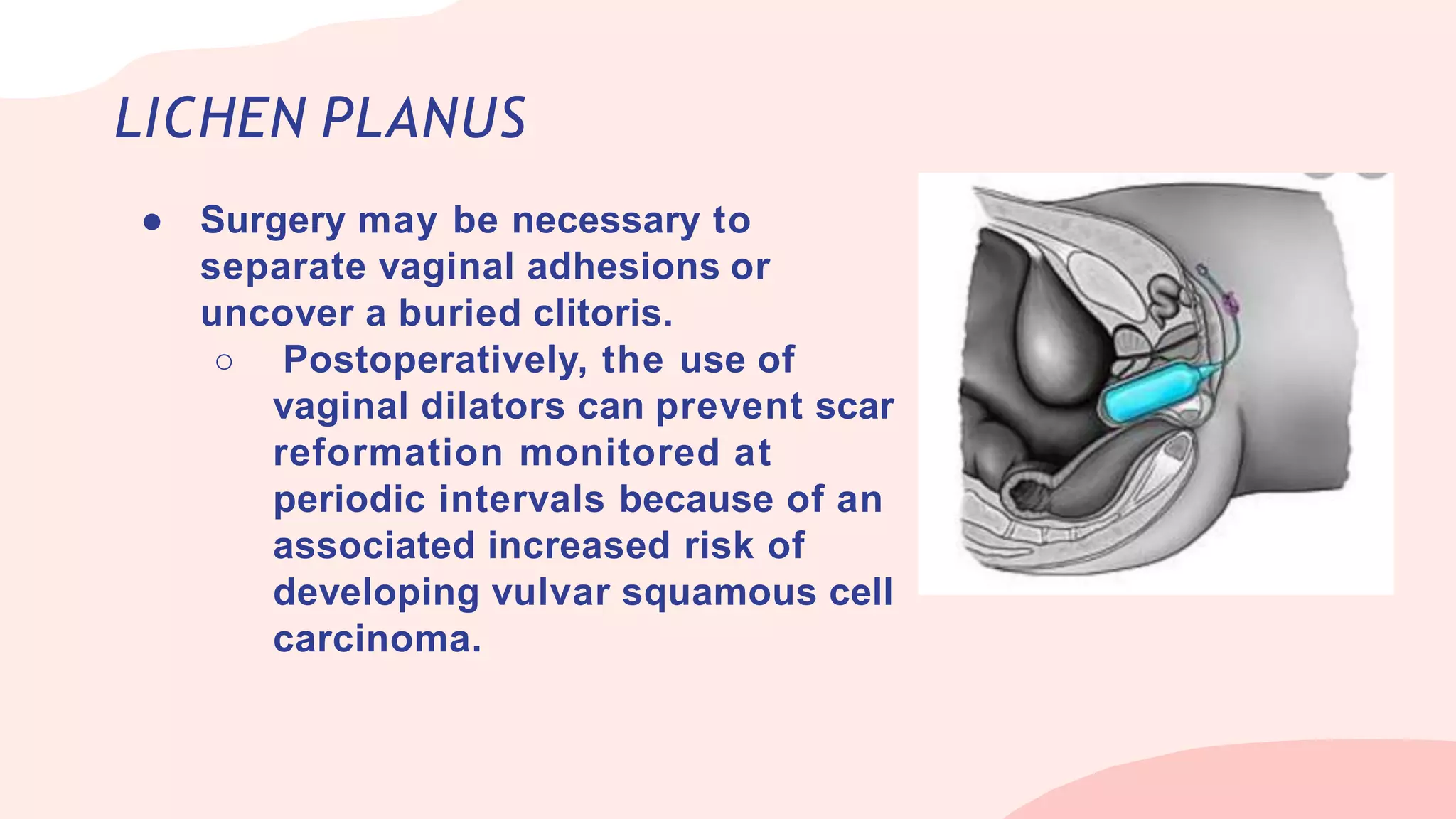 Benign Gynecologic Lesions.pptx