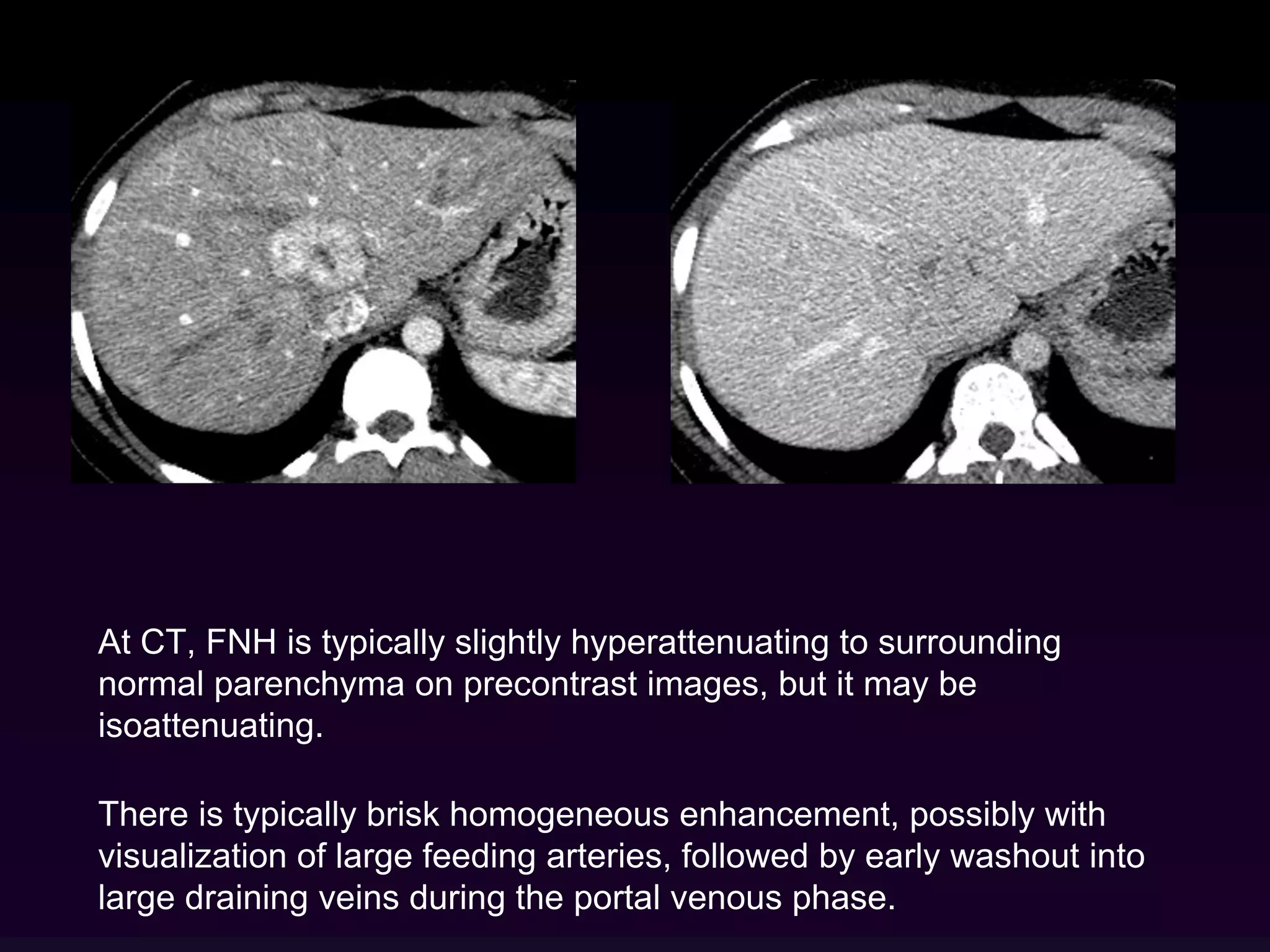 Imaging in Benign hepatic lesions | PPTX