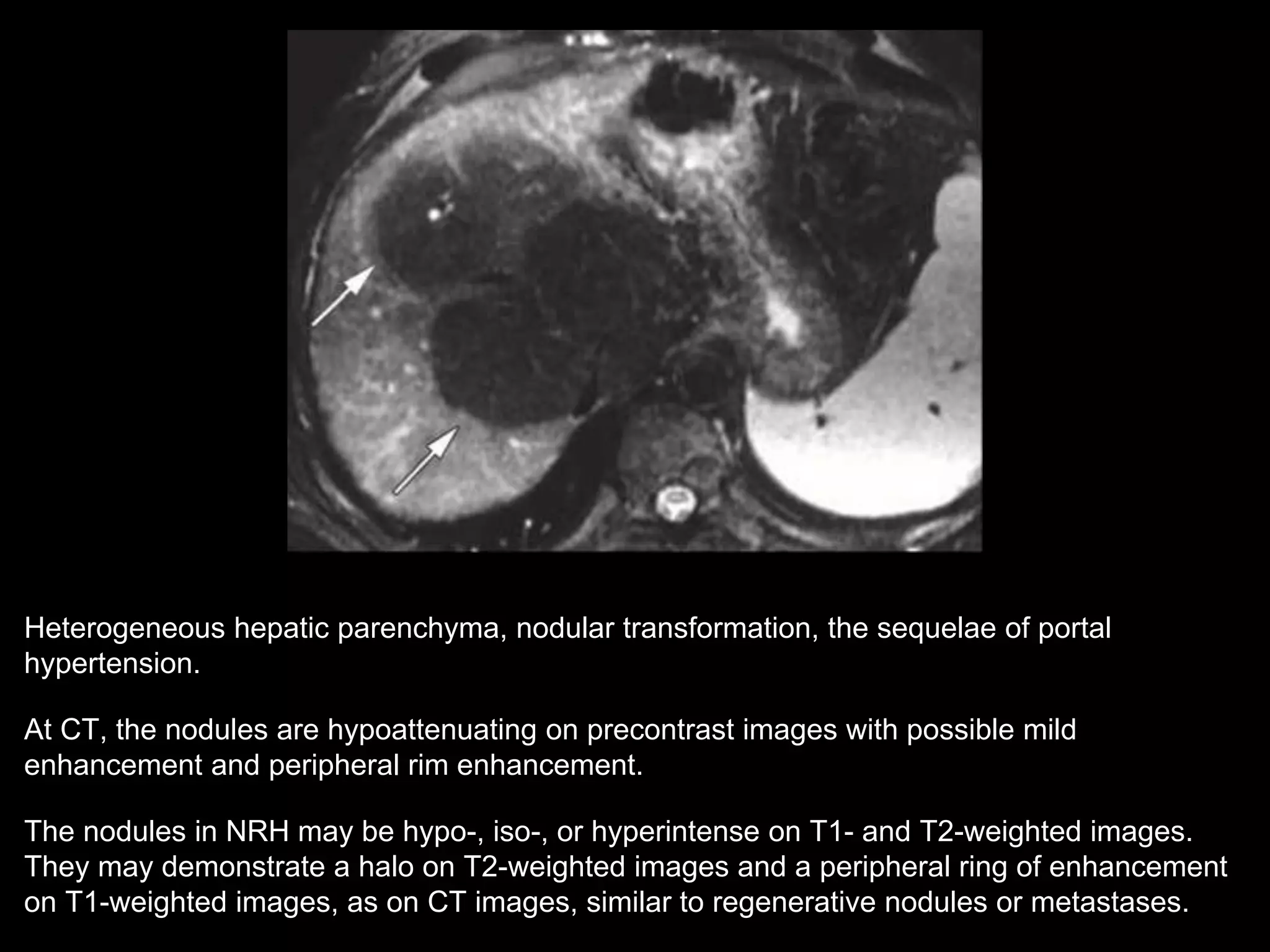 Imaging in Benign hepatic lesions | PPTX