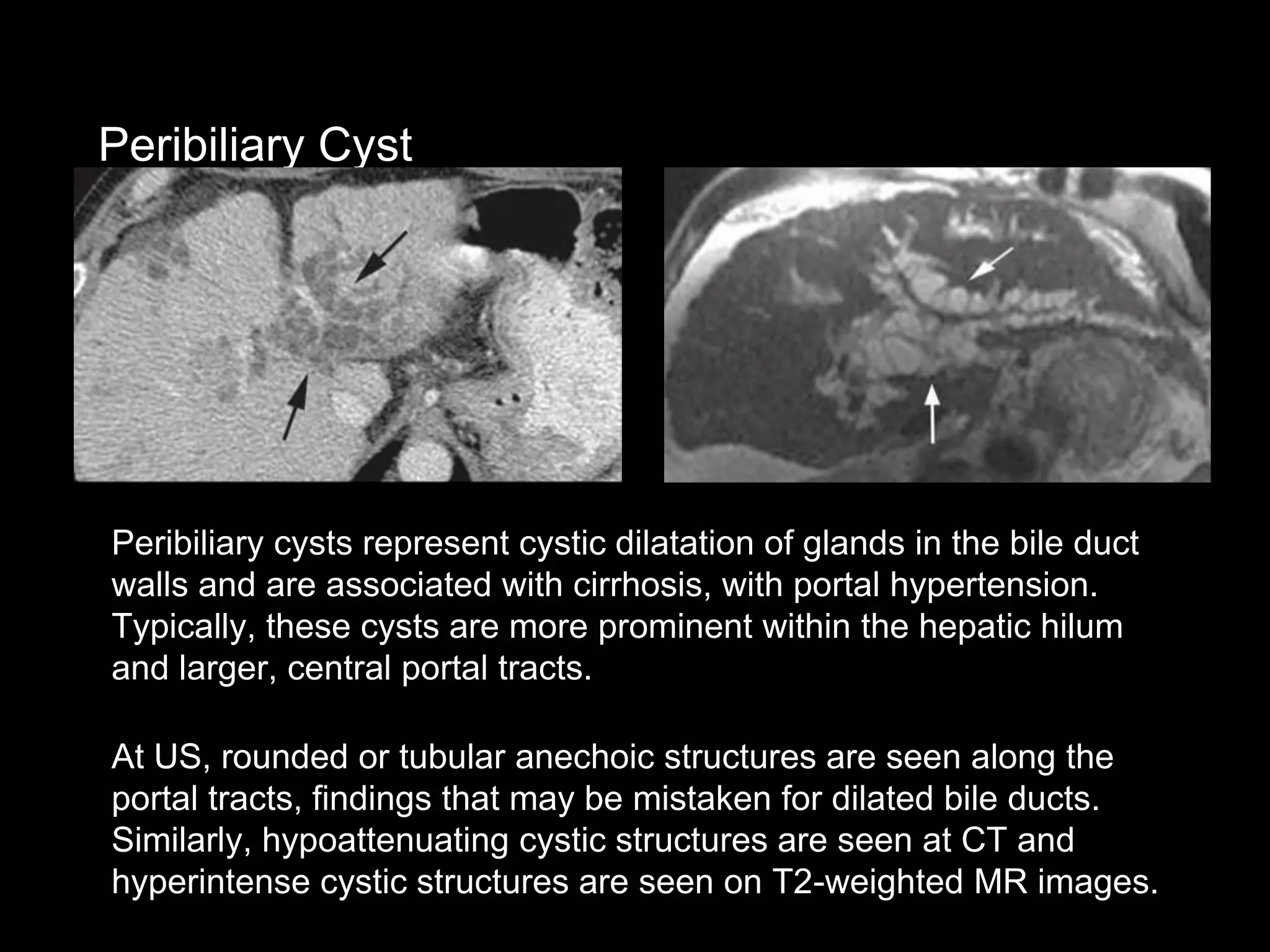 Imaging In Benign Hepatic Lesions Ppt