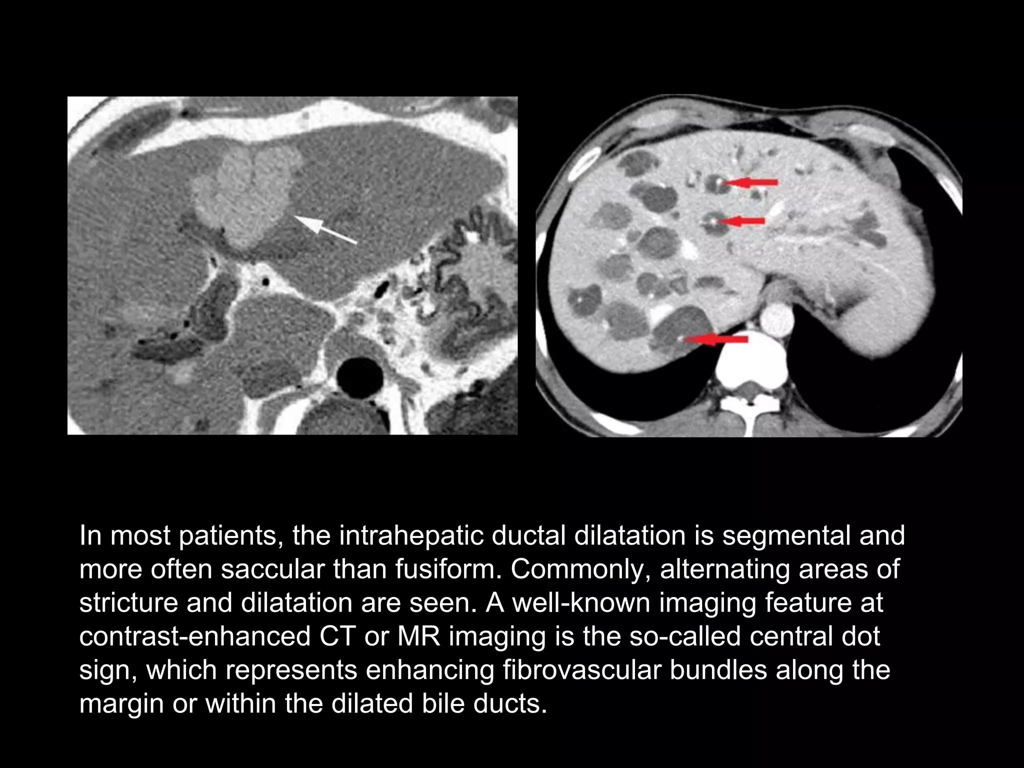 Imaging in Benign hepatic lesions | PPTX