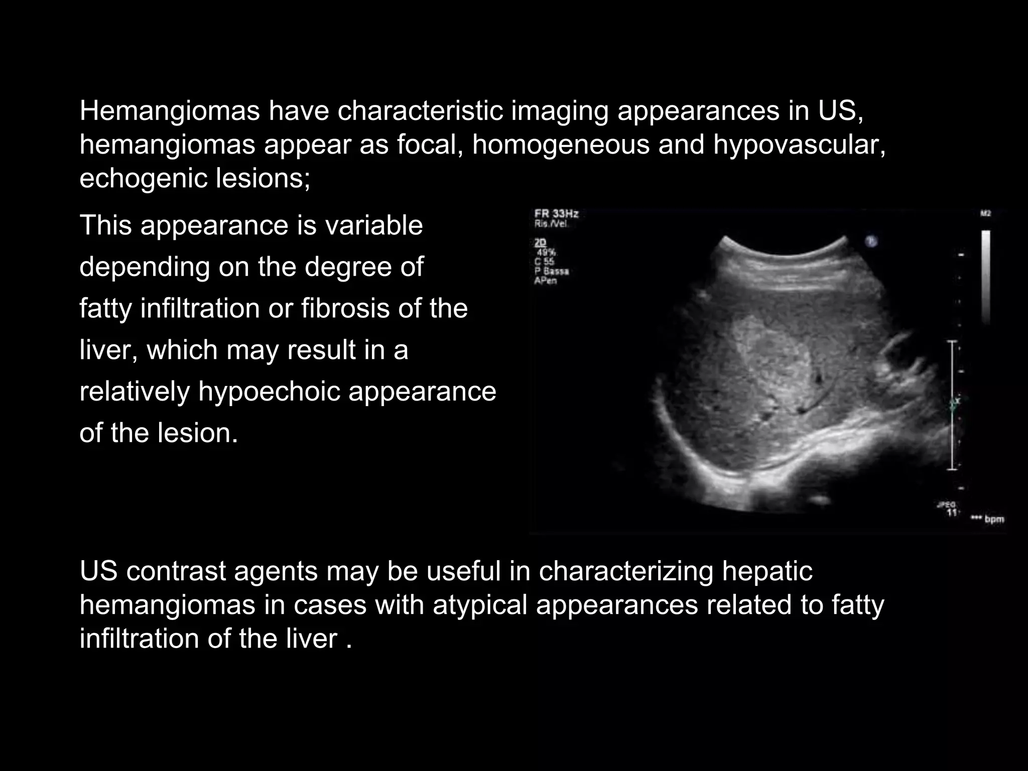 Imaging In Benign Hepatic Lesions Ppt