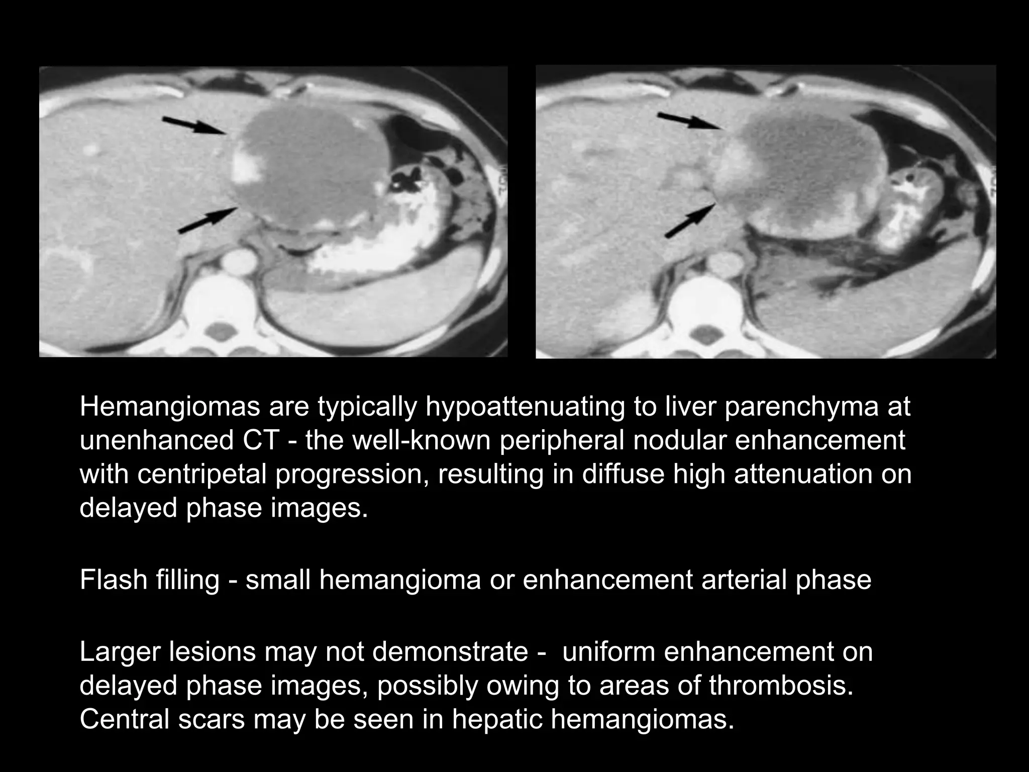 Imaging in Benign hepatic lesions | PPTX
