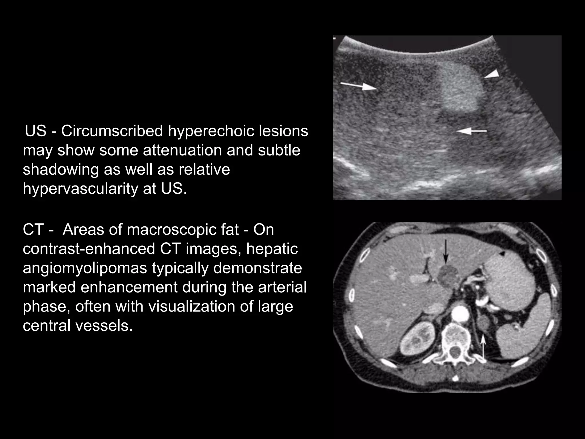 Imaging in Benign hepatic lesions | PPTX