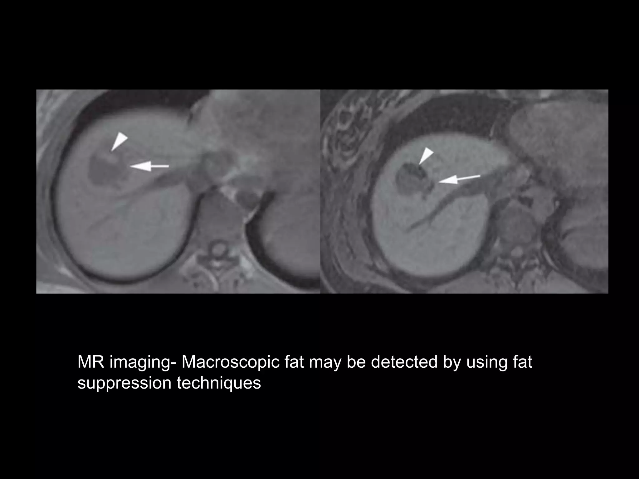 Imaging in Benign hepatic lesions | PPTX