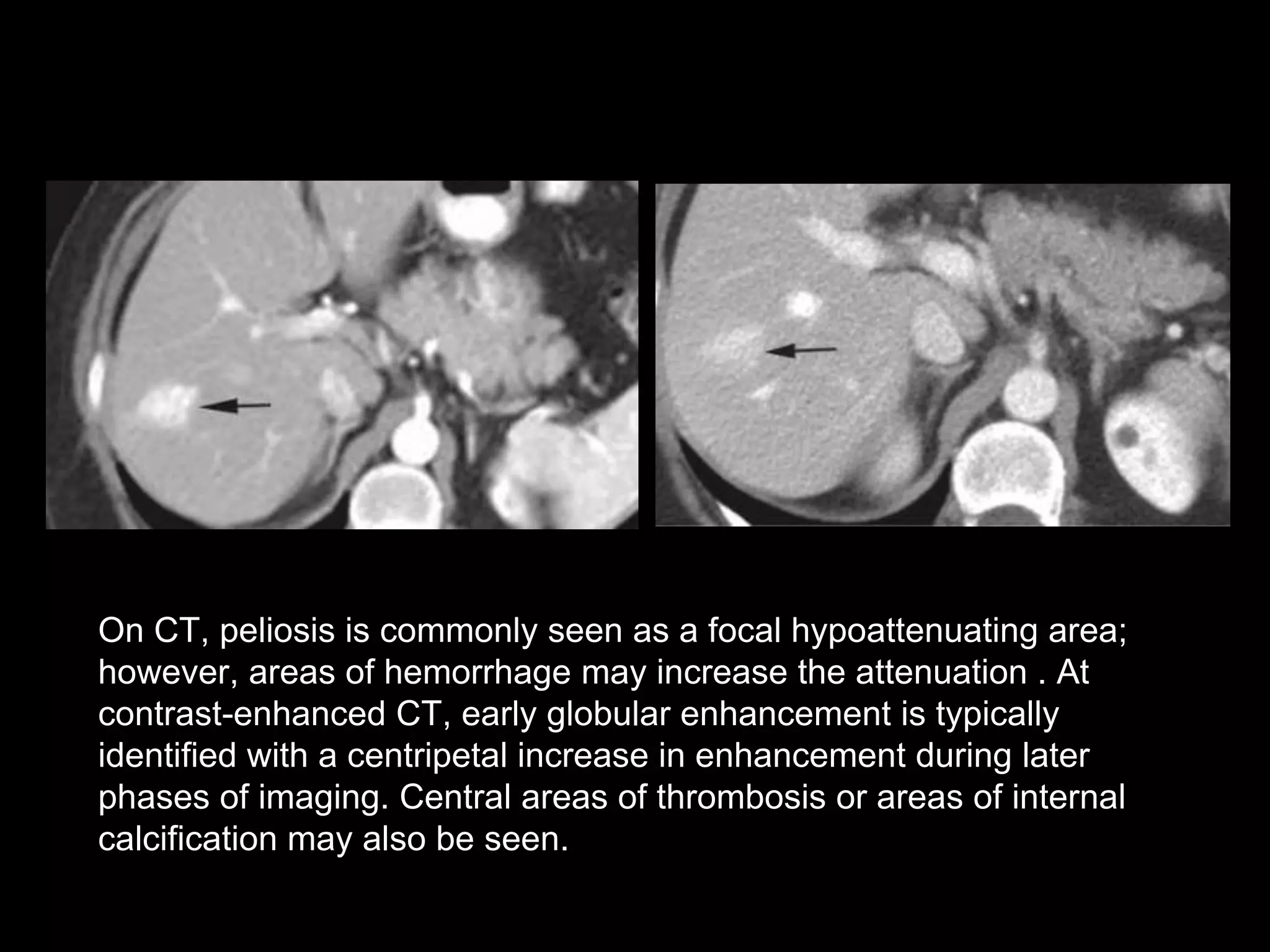 Imaging in Benign hepatic lesions | PPTX