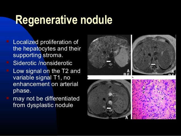 imaging of benign hepatic masses