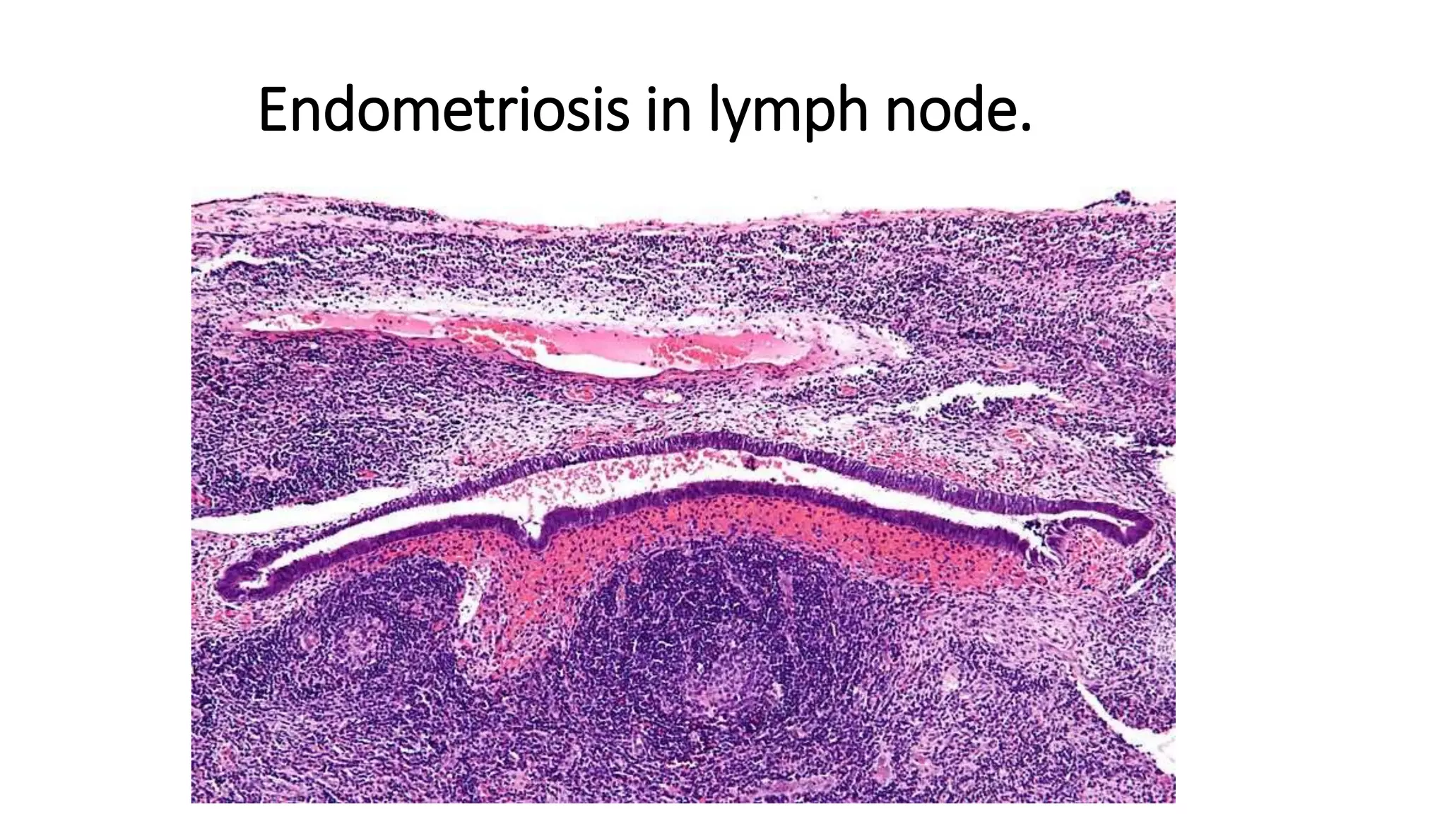 Benign inclusions in lymph nodes histopathology | PPT