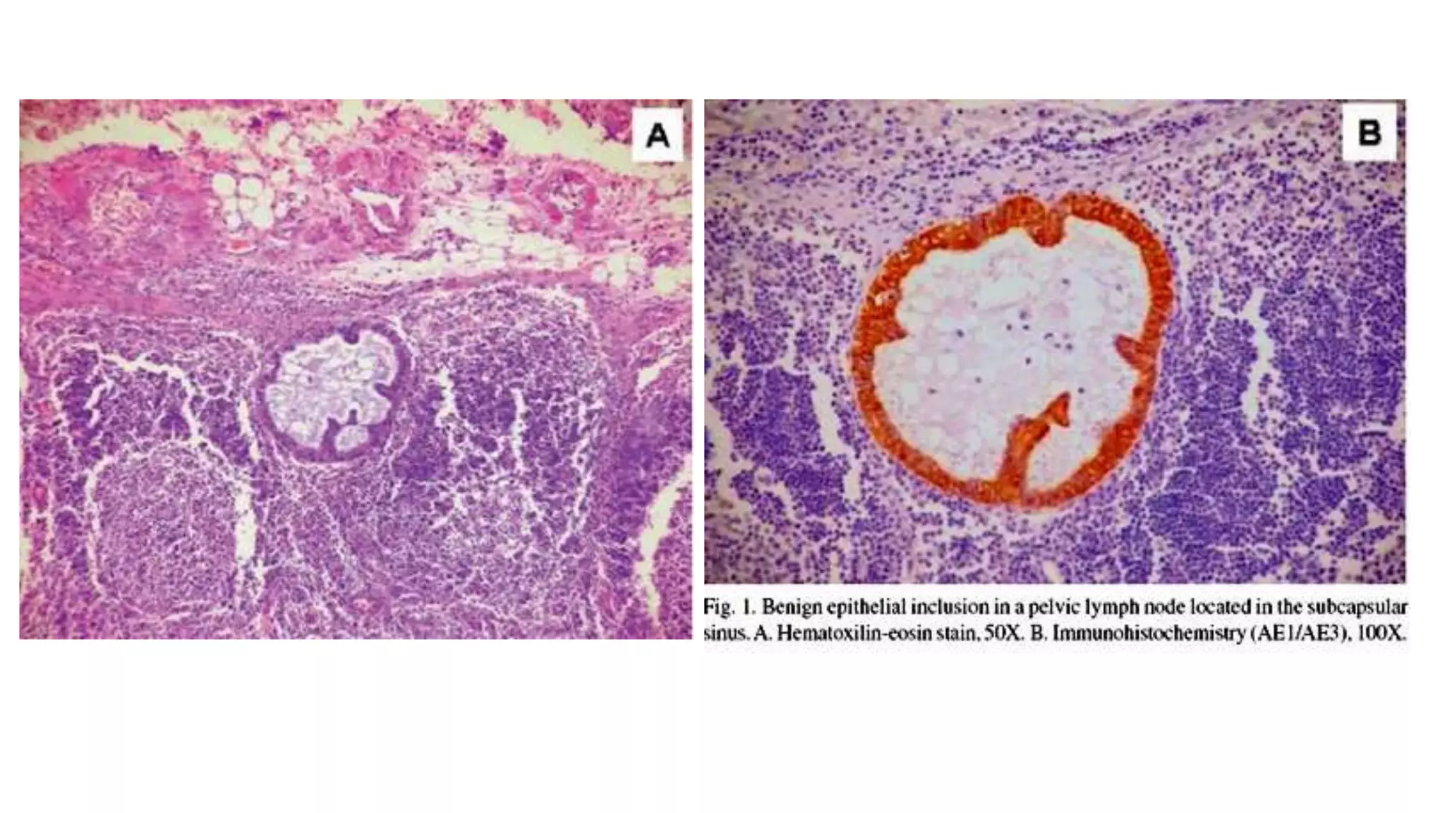 Benign inclusions in lymph nodes histopathology | PPTX
