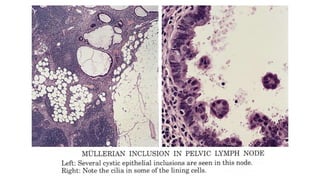 Benign inclusions in lymph nodes histopathology | PPTX