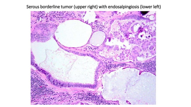 Benign inclusions in lymph nodes histopathology | PPTX