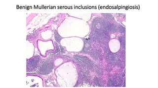 Benign inclusions in lymph nodes histopathology | PPTX