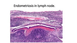 Benign inclusions in lymph nodes histopathology | PPTX