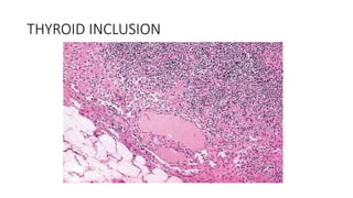 Benign inclusions in lymph nodes histopathology | PPTX