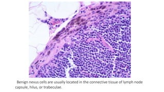 Benign inclusions in lymph nodes histopathology | PPTX