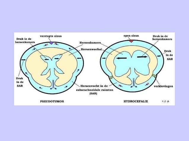 Benign intracranial hypertension by Dr.Syed Alam Zeb | PPT | Ear, Nose ...