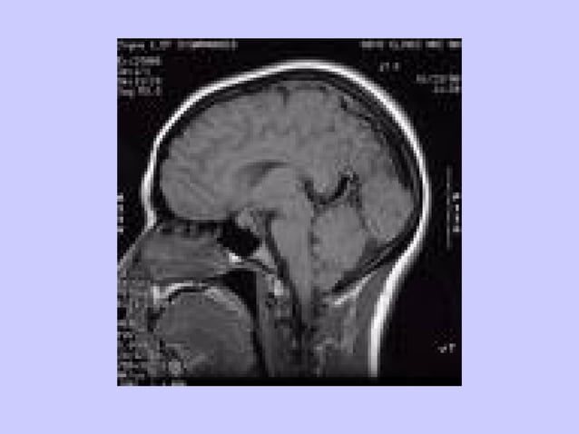 Benign intracranial hypertension by Dr.Syed Alam Zeb | PPT | Ear, Nose ...