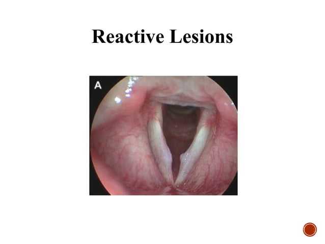Benign Laryngeal lesions managements.pptx