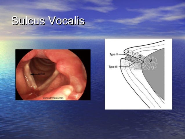 Benign laryngeal lesions presentation