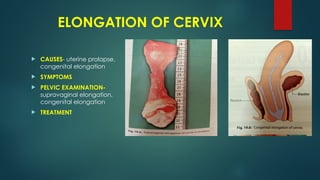 benign lesion of cervix.pptx benign lesion of cervix | PPT