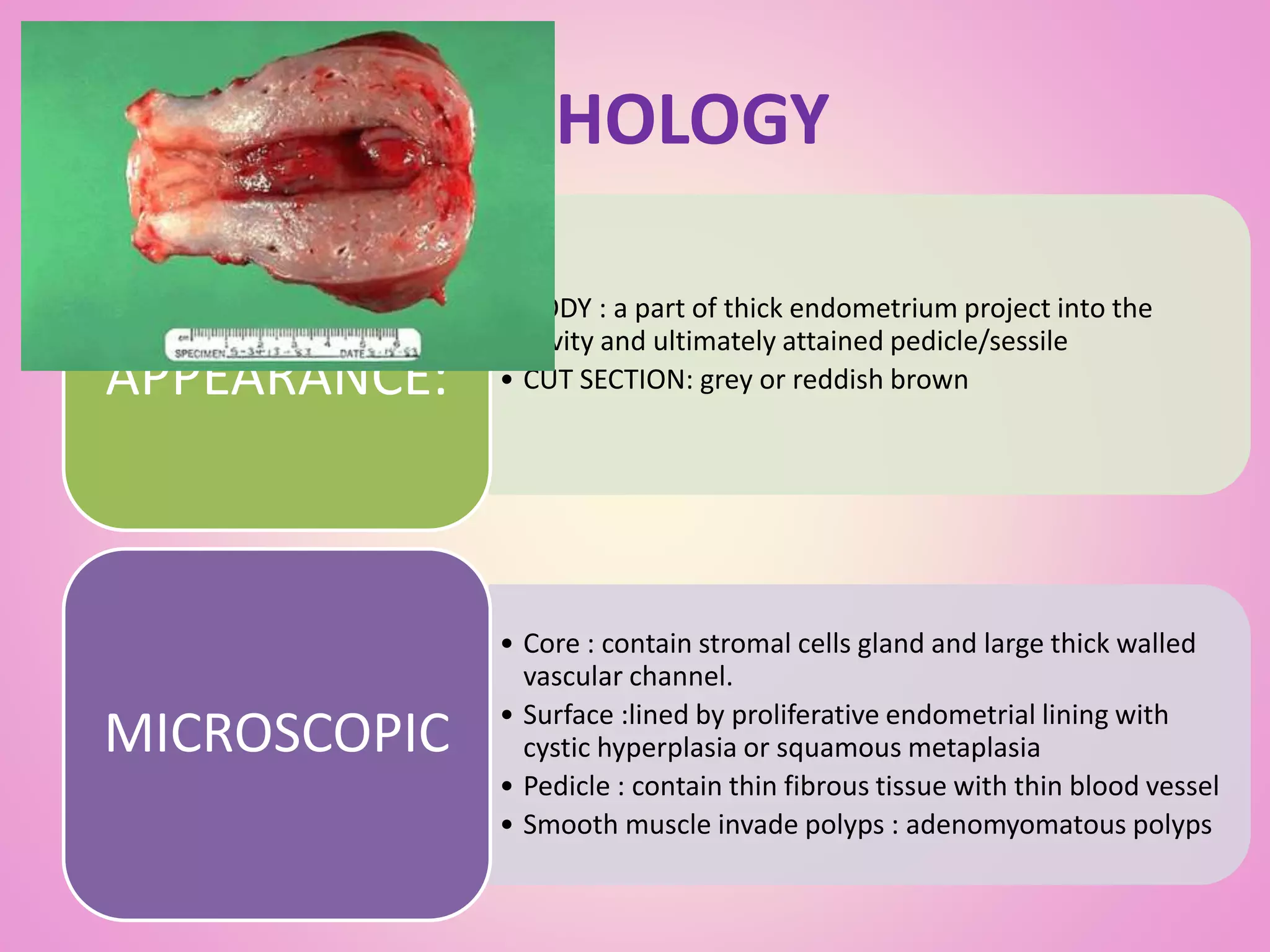 Benign lesion of the uterus | PPTX