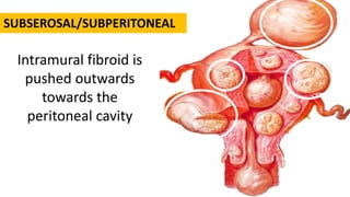 BENIGN LESIONS OF UTERUS | PPTX