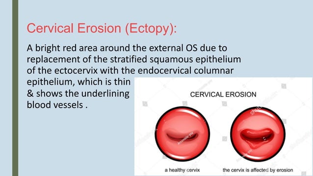 Benign lesions of cervix | PPTX
