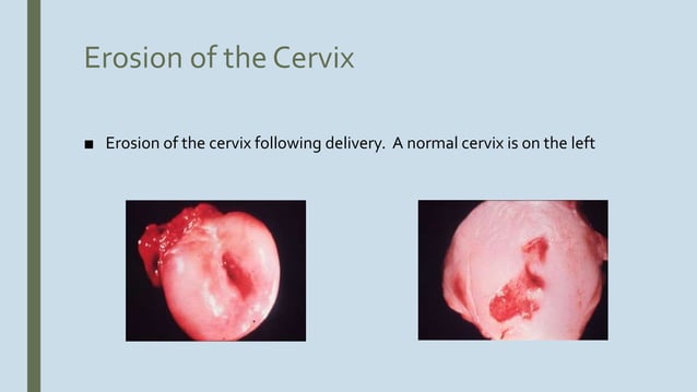 Benign lesions of cervix