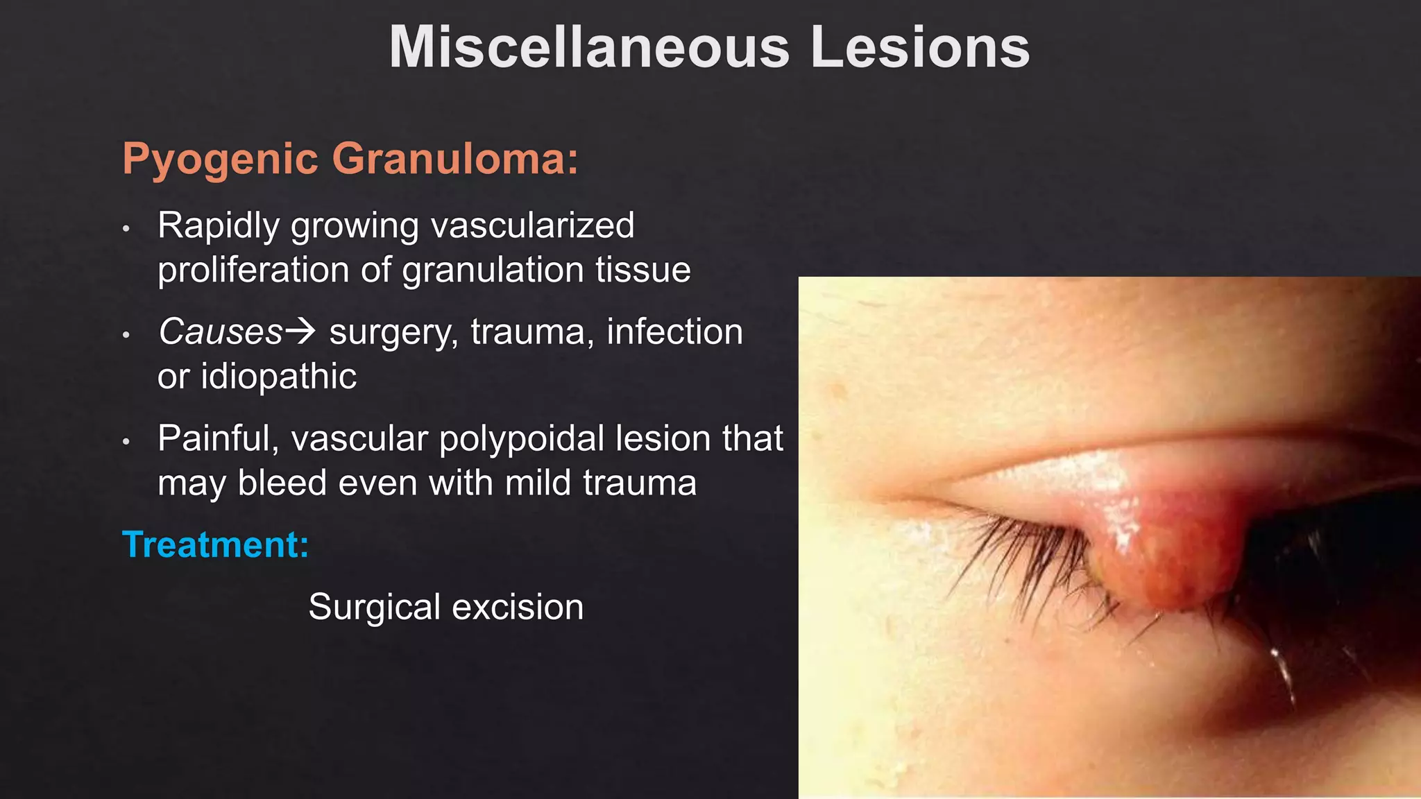 Benign Lesions of Eyelids by Dr. Muhammad Zeeshan Hameed | PPTX
