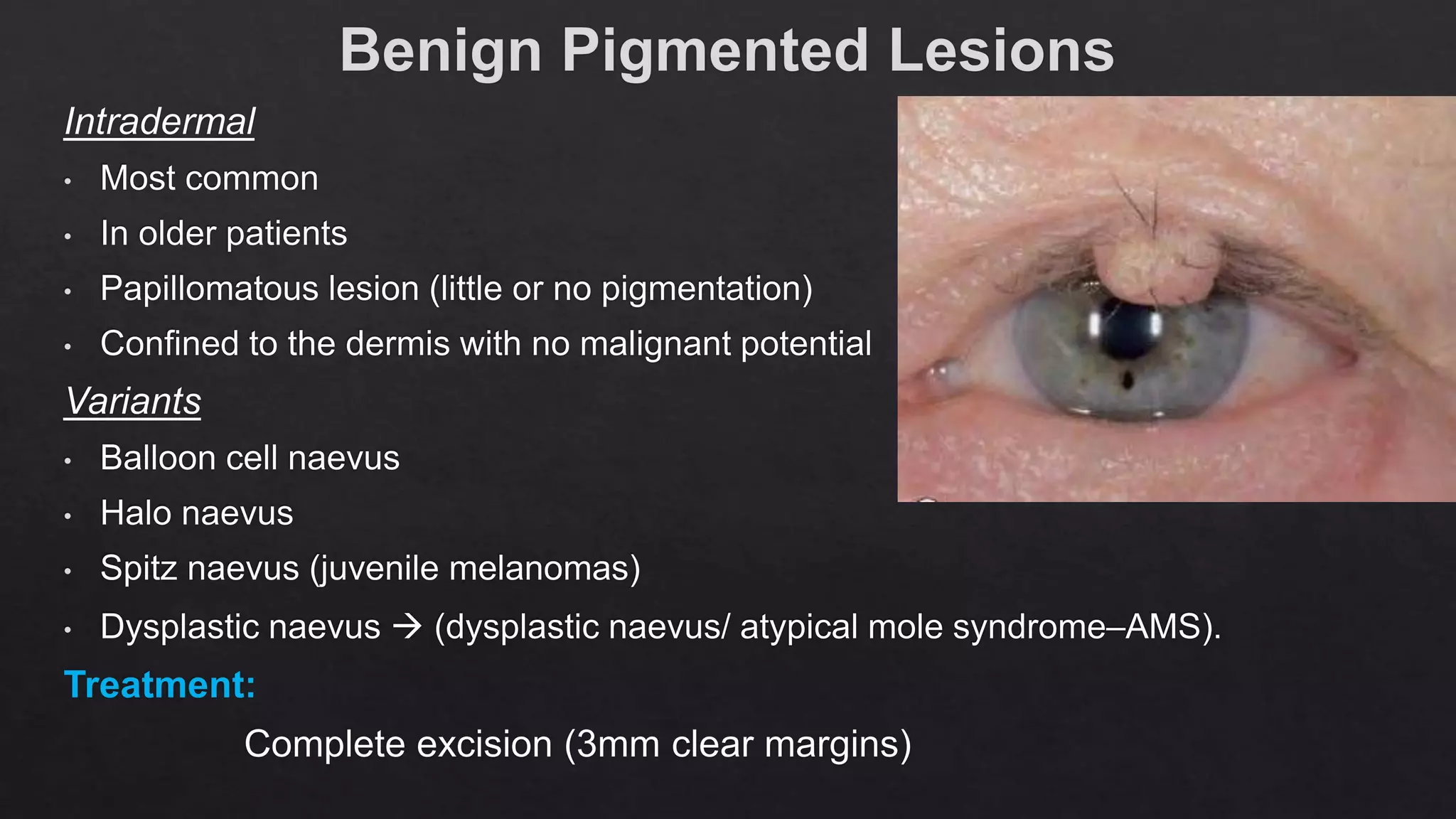 Benign Lesions of Eyelids by Dr. Muhammad Zeeshan Hameed | PPTX