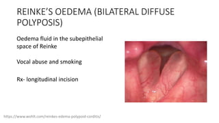 Benign lesions of larynx | PPTX