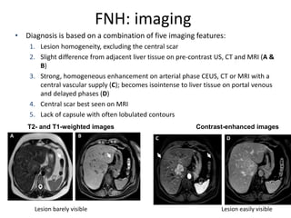 benign lesions of liver.pptx | Endocrine and Metabolic Diseases ...