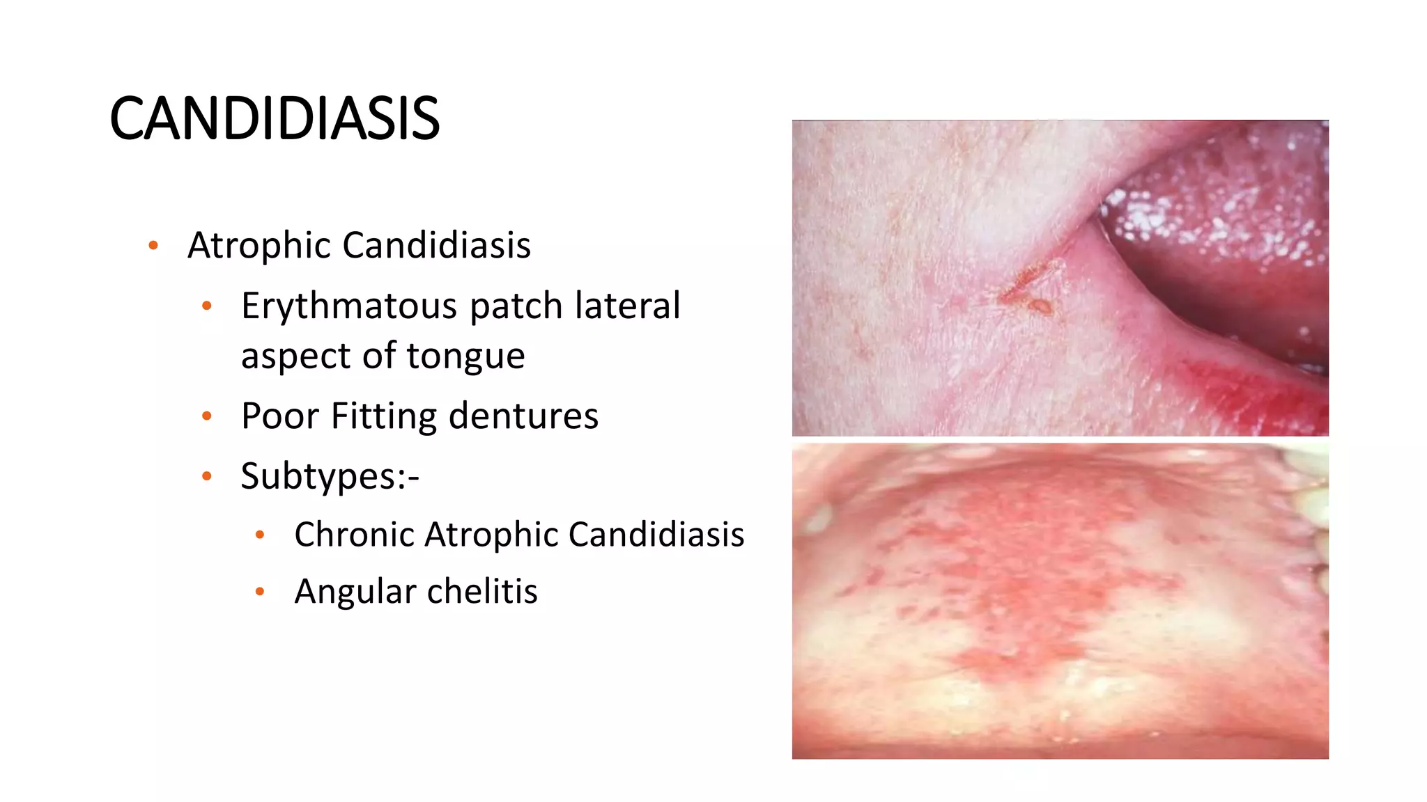 Benign Lesions of Oral Cavity.pptx