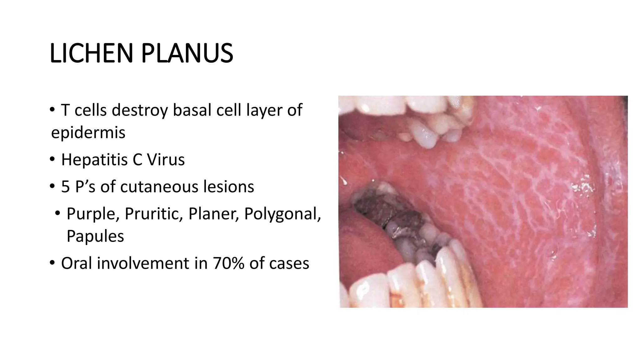 Benign Lesions of Oral Cavity.pptx