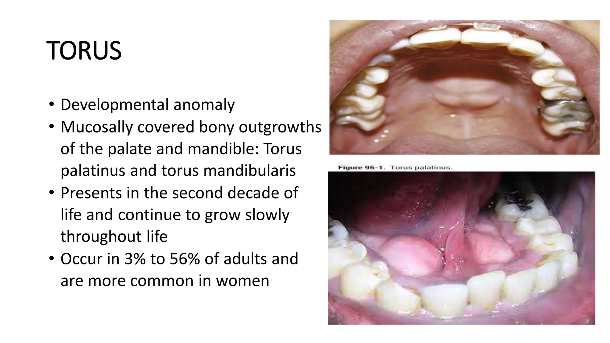 Benign Lesions of Oral Cavity.pptx