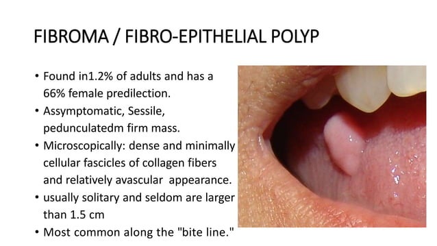 Benign Lesions of Oral Cavity.pptx | Thyroid Disorders | Endocrine and ...