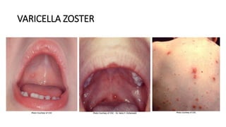 Benign Lesions of Oral Cavity.pptx