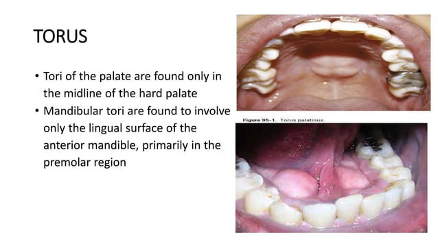 Benign Lesions of Oral Cavity.pptx | Thyroid Disorders | Endocrine and ...
