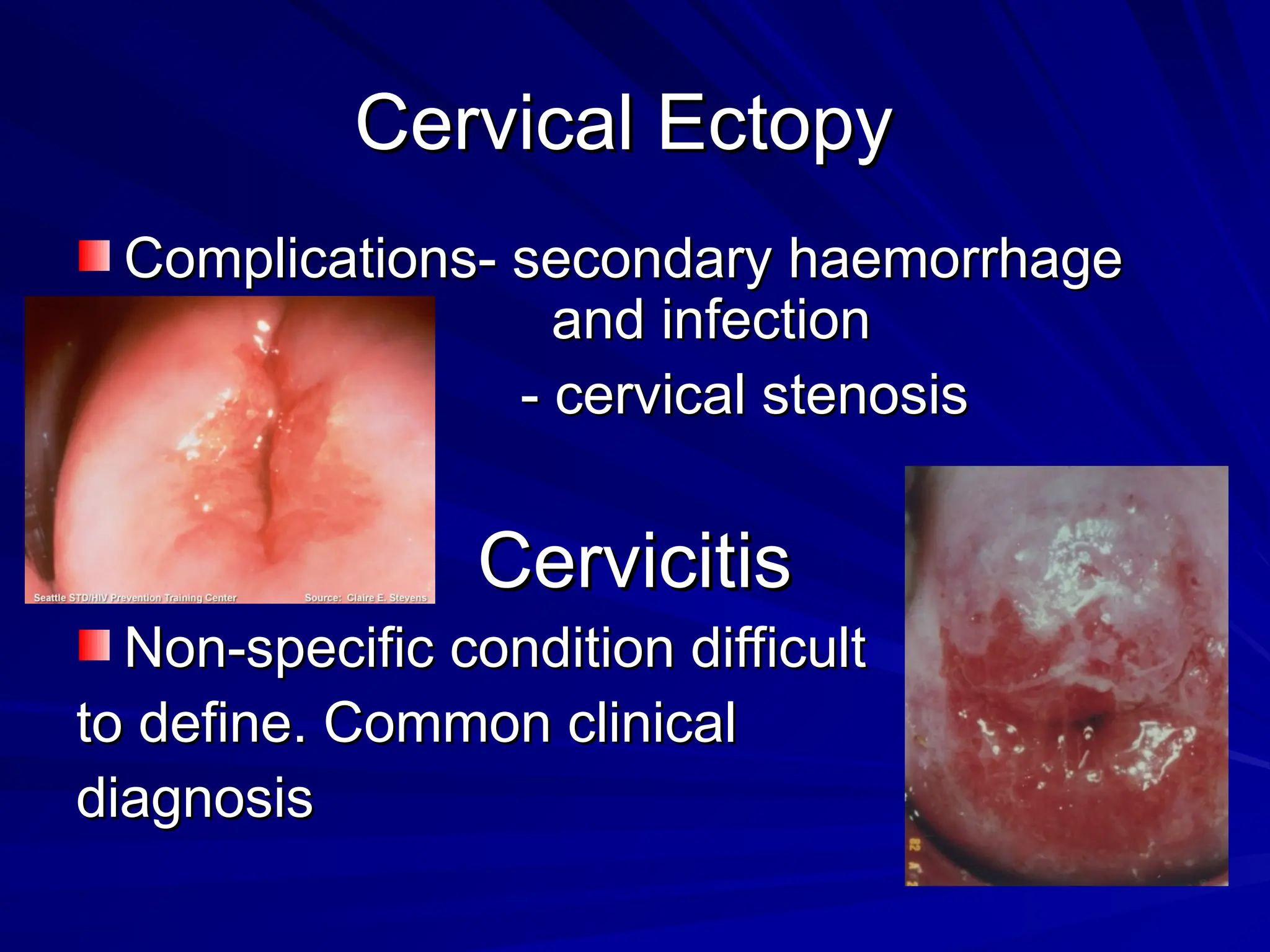 benignlesionsofthecervixvaginaandvulva-120205030502-phpapp02.ppt