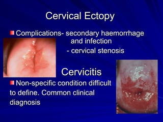 benignlesionsofthecervixvaginaandvulva-120205030502-phpapp02.ppt