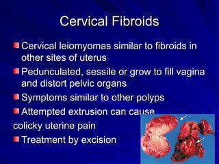 benignlesionsofthecervixvaginaandvulva-120205030502-phpapp02.ppt