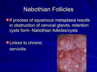 benignlesionsofthecervixvaginaandvulva-120205030502-phpapp02.ppt