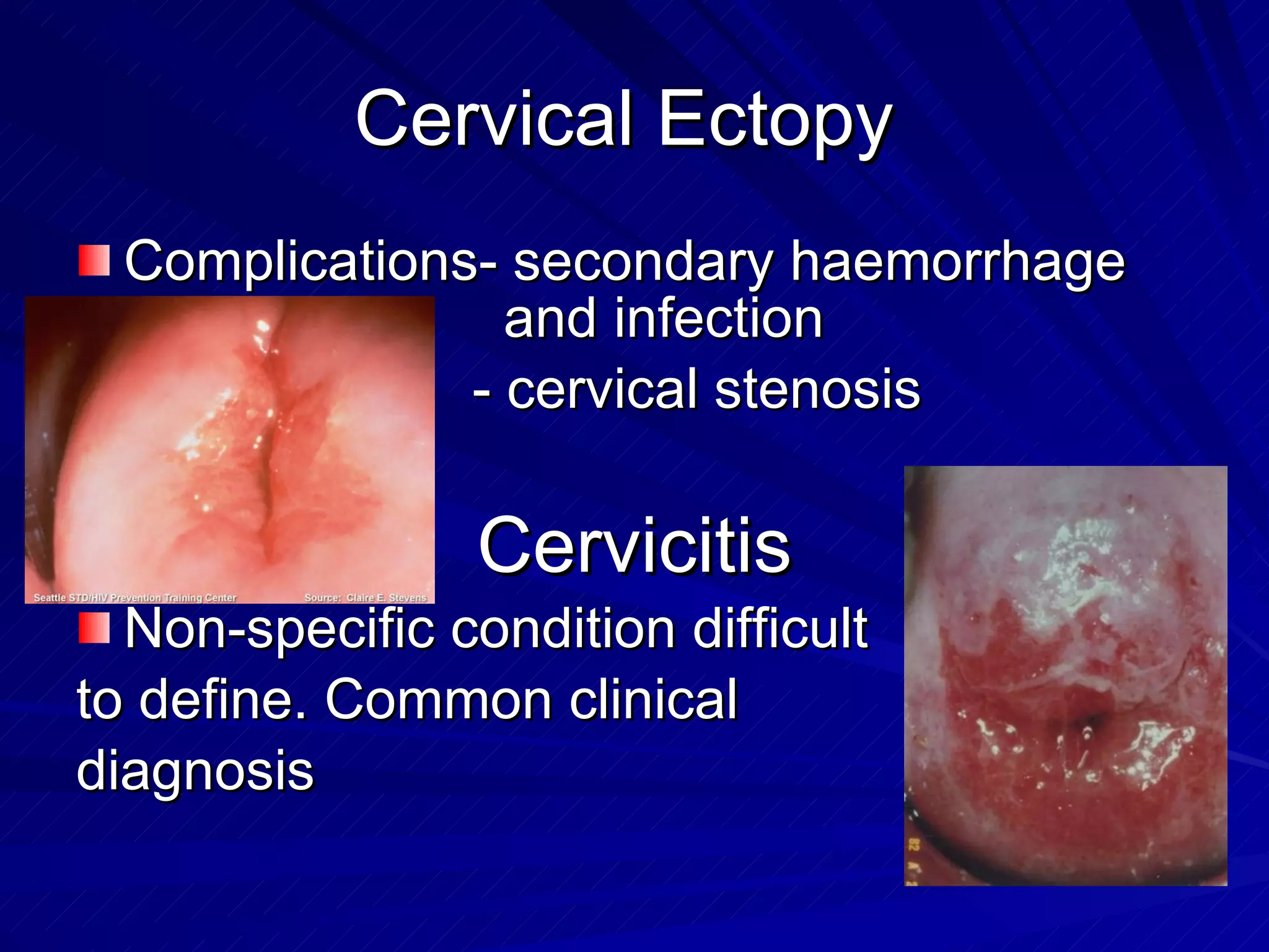 Benign Lesions Of The Cervix Vagina And Vulva Ppt