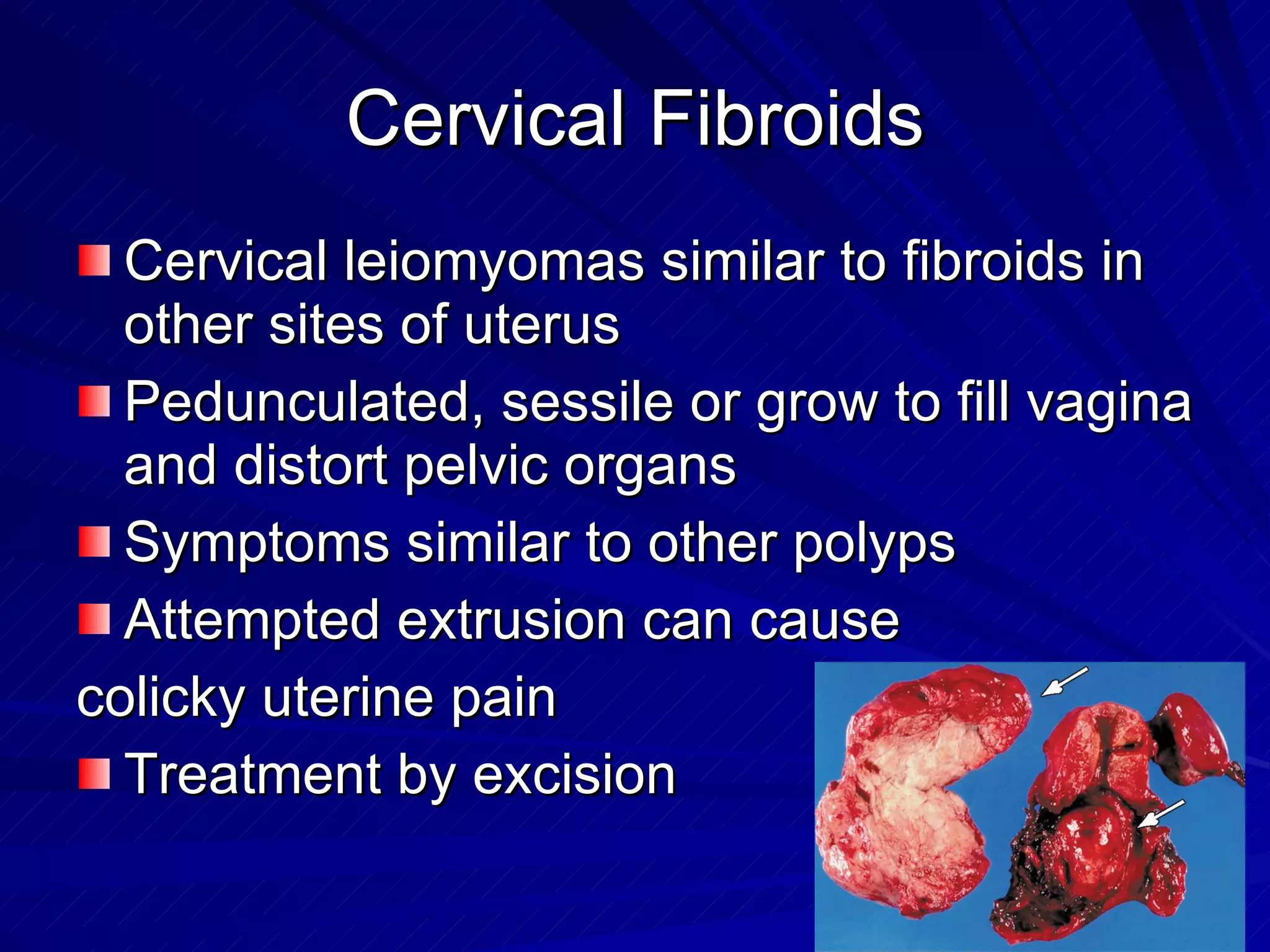 Benign lesions of the cervix, vagina and vulva | PPT